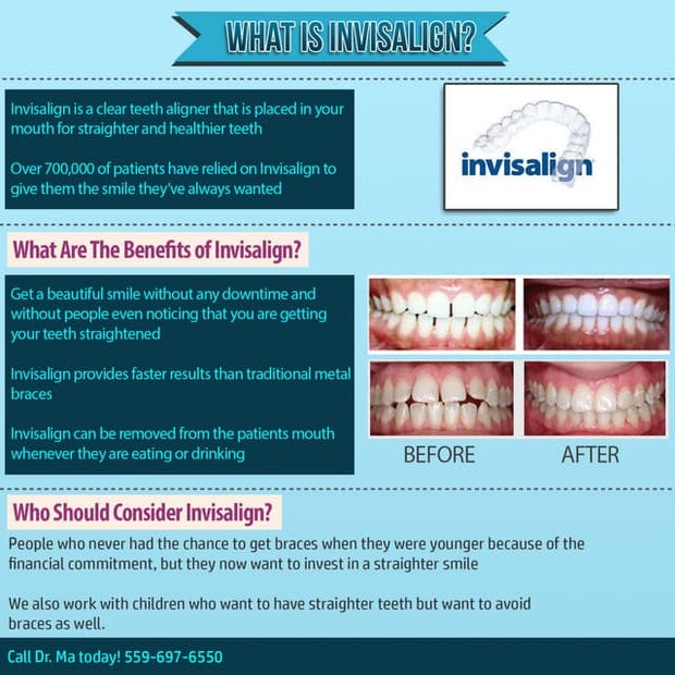 What Is Invisalign | PPT