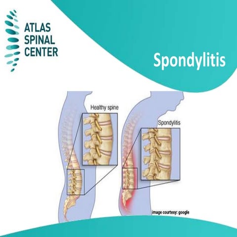 What is spondylitis | PPSX