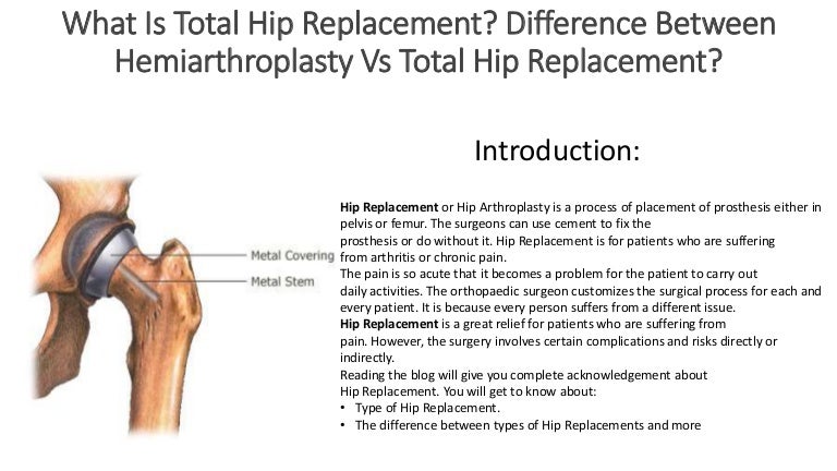 What Is Total Hip Replacement? Difference Between Hemiarthroplasty Vs…