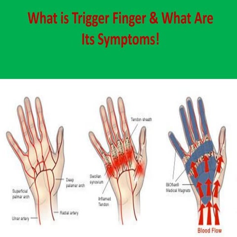 What is trigger finger & what are its symptoms! | PDF