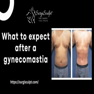 What to Expect After Gynecomastia Surgery | PPTX