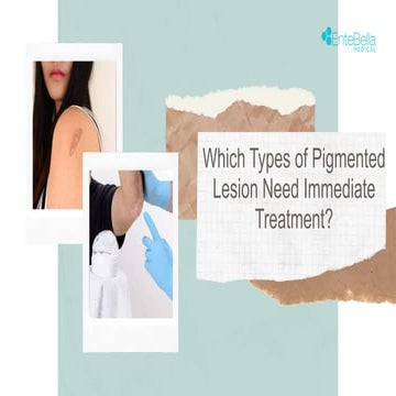 Which Types of Pigmented Lesion Need Immediate Treatment | PPT