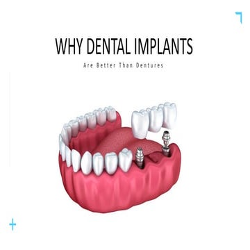 Why Dental Implants are Better Than Dentures | PDF