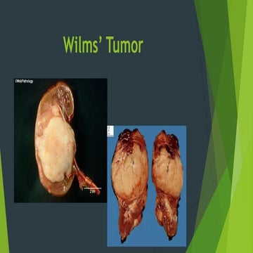 Wilms tumor | PPTX | Cancer | Diseases and Conditions