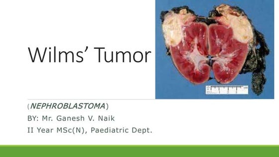 Wilms tumor | PPTX