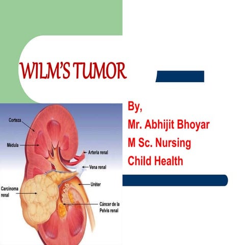 Wilms tumor | PPTX