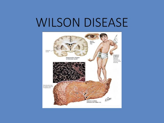 Wilson's disease (wilson) | PPTX