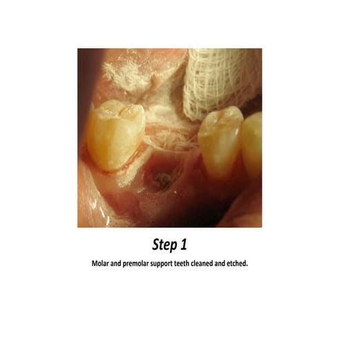 Carlson Bridge® “Winged Pontic” Tooth Replacement Systems Kit ...