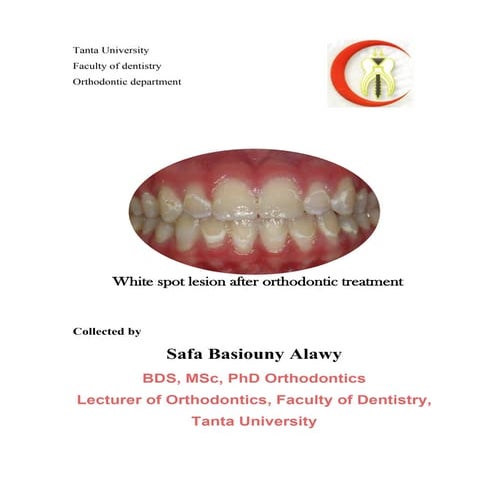 Strategies for Managing White Spot Lesions in Orthodontic Patients and ...