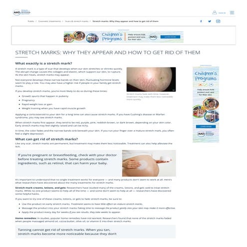 STRETCH MARKS: WHY THEY APPEAR AND HOW TO GET RID OF THEM | PDF