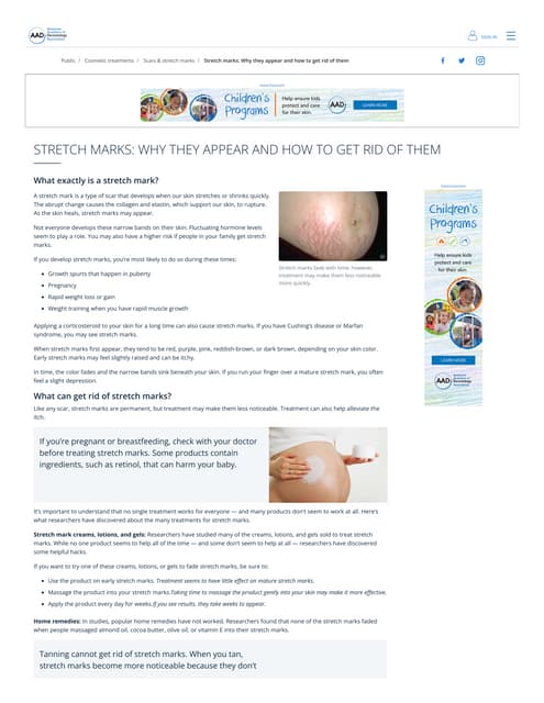 Guide to Treating Stretch Marks | PPT
