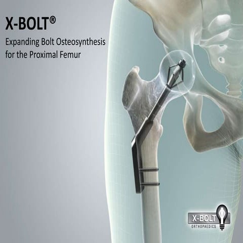 Hip Fracture Fixation with X-Bolt | PPTX