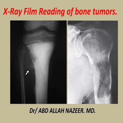 X ray film reading for bone tumour. | PPTX