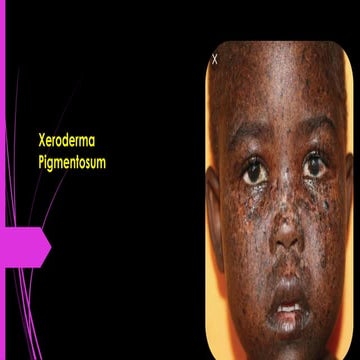Xeroderma pigmentosum a genetic disorder.pptx