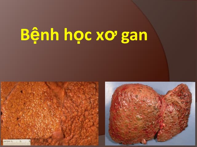 Áp-xe gan | PDF