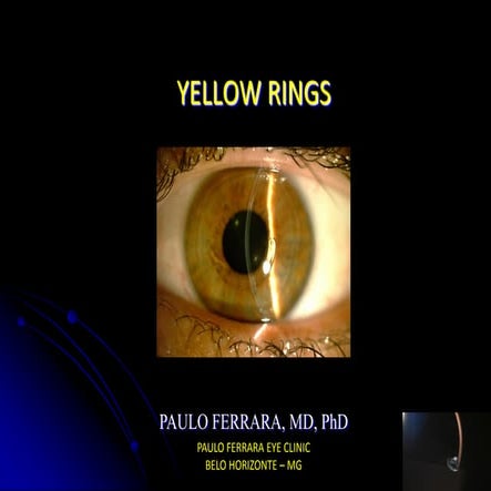 Keratoconus. Yellow Rings | PDF