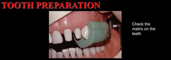 Tooth Preparation - Maryland preps | PDF