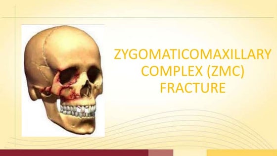 ZYGOMATICOMAXILLARY FRACTURES AND MANAGEMENT | PPT