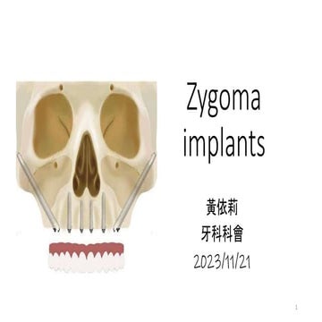 Zygoma implants Zygoma implants Zygoma implants | PPTX