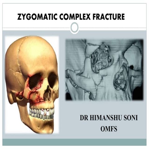 Zygomatic Complex Fracture- ZMC | PPTX