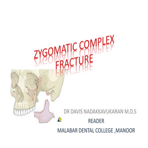 ZYGOMATIC COMPLEX FRACTURE DAVISpptx | PPTX