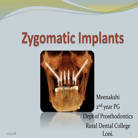Zygomatic Implants The Anatomy Guided Approach Product Review: