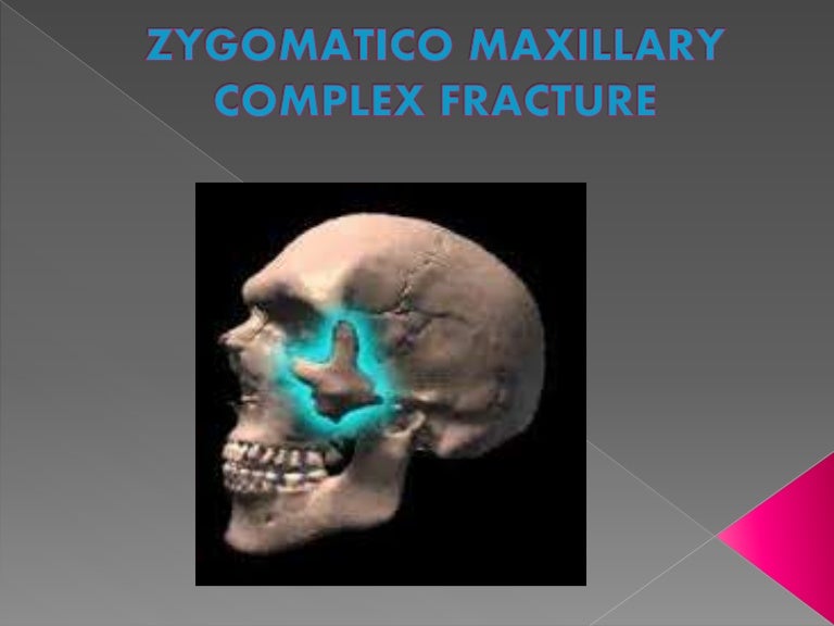 ZYGOMATICO MAXILLARY COMPLEX FRACTURE